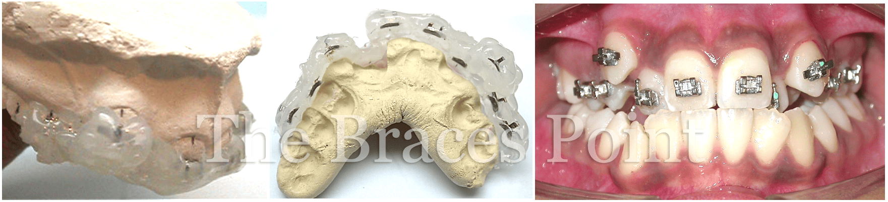 Innovations - The Braces Point