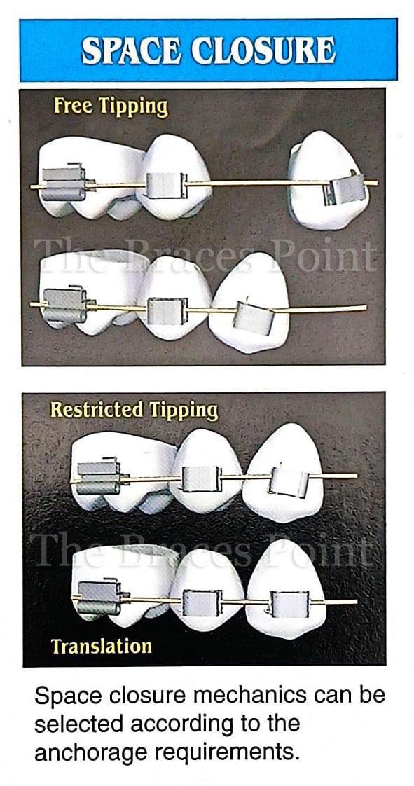 Innovations - The Braces Point